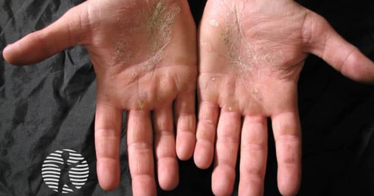 Palmoplantar psoriasis image