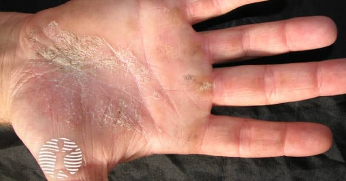 Palmoplantar psoriasis image