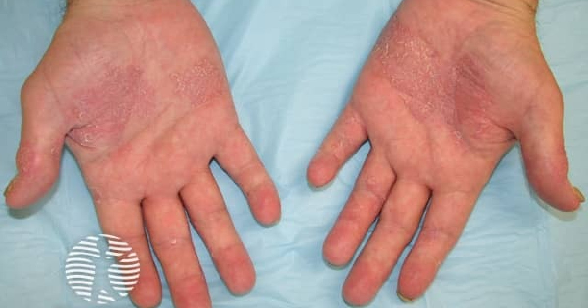 Palmoplantar psoriasis image