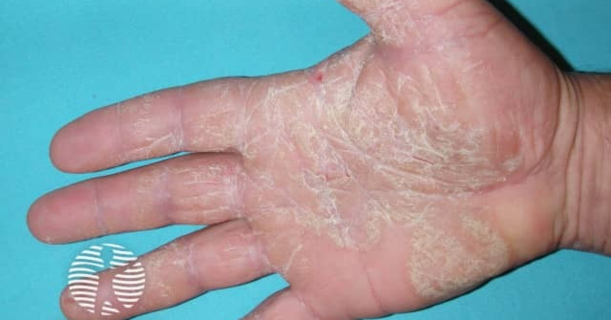 Palmoplantar psoriasis image