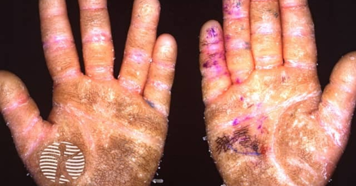 Palmoplantar psoriasis image