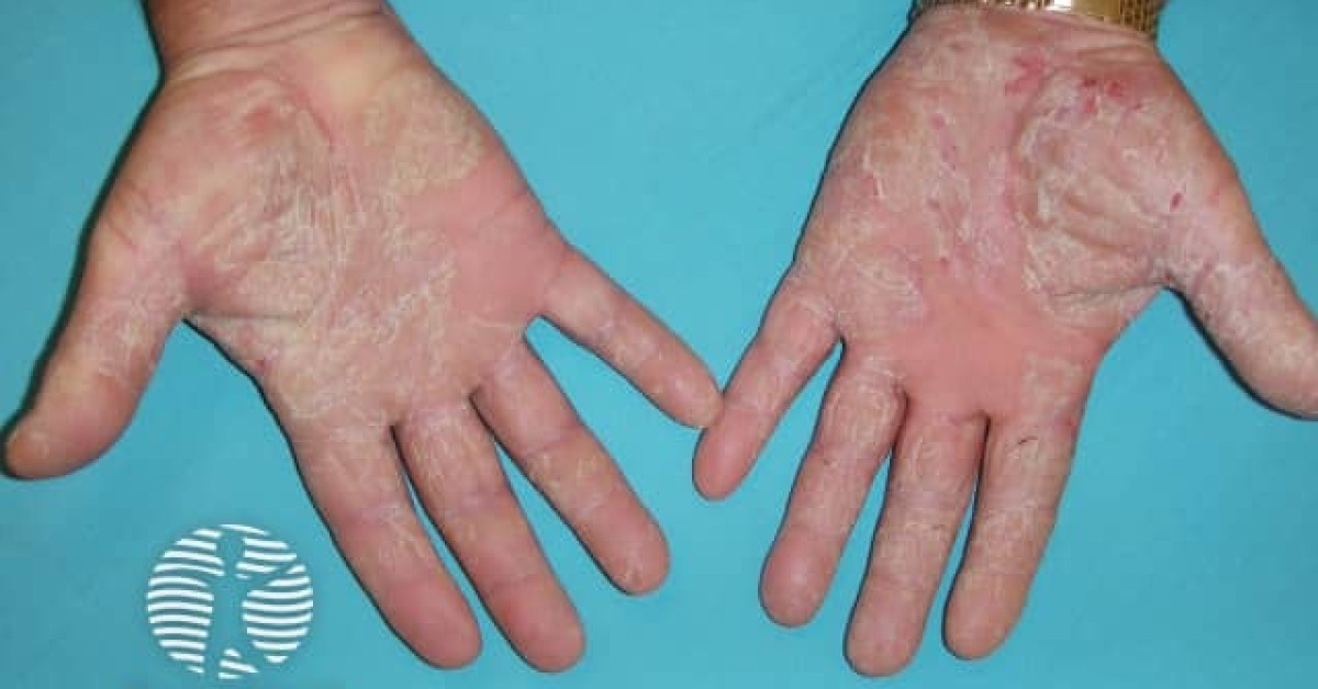 Palmoplantar psoriasis image