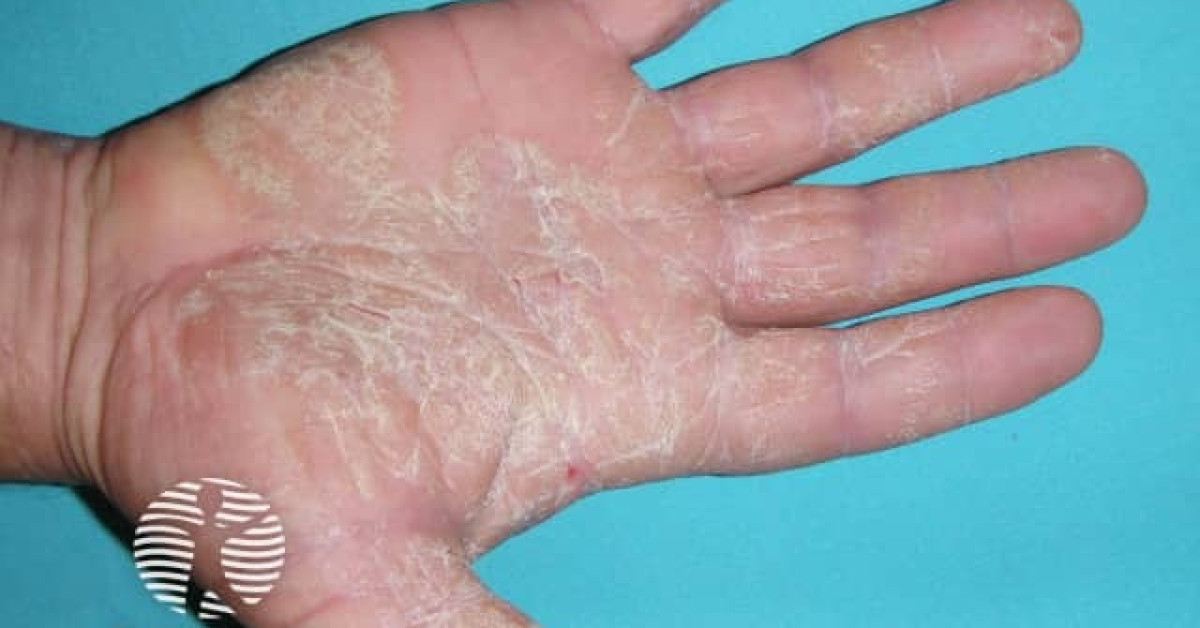 Palmoplantar psoriasis image