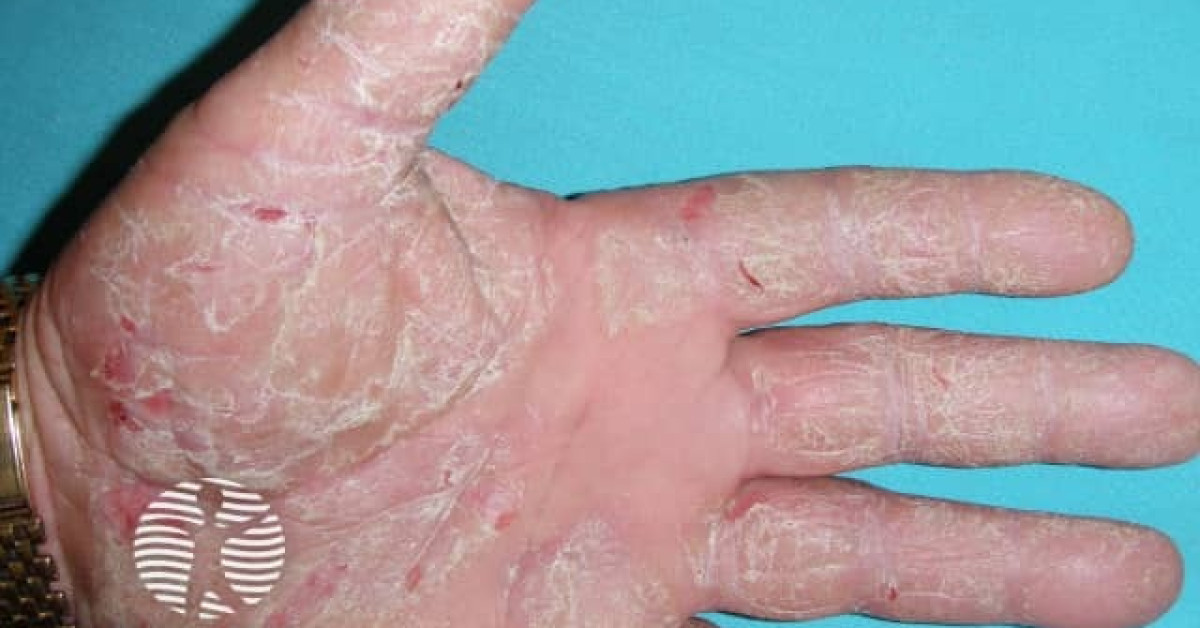 Palmoplantar psoriasis image