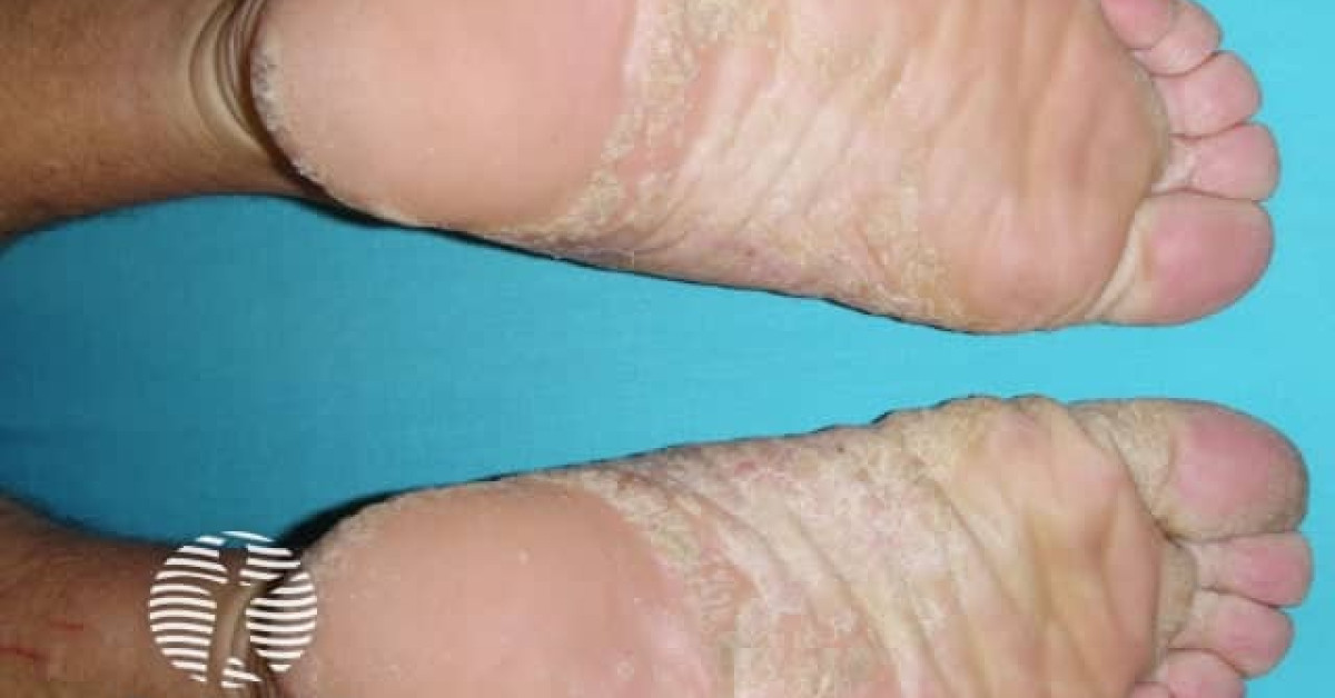 Palmoplantar psoriasis image
