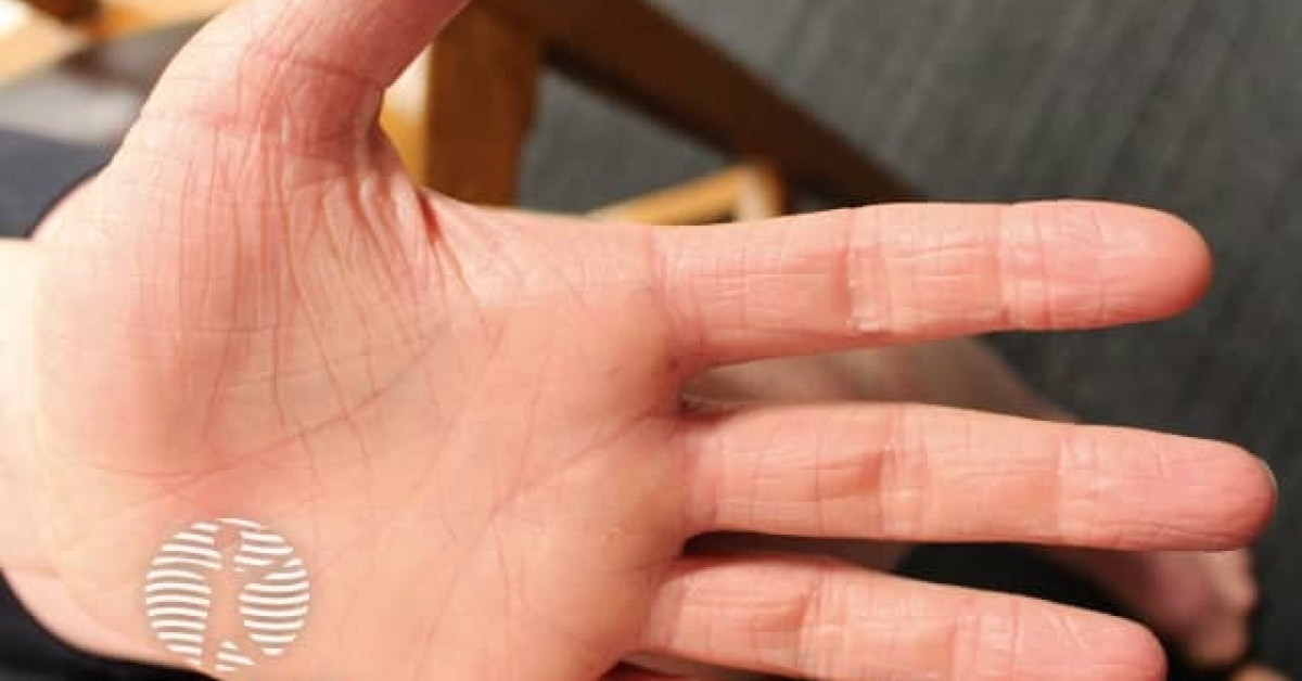 Circumscribed juvenile-onset pityriasis rubra pilaris image