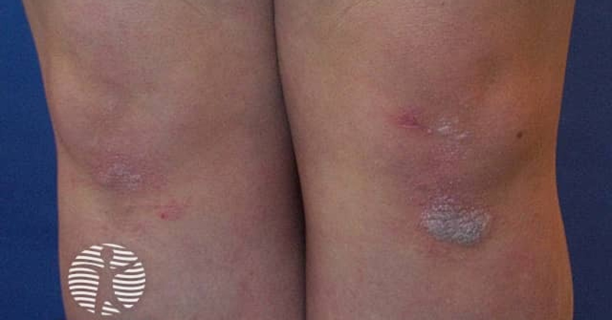 Pityriasis rubra pilaris image