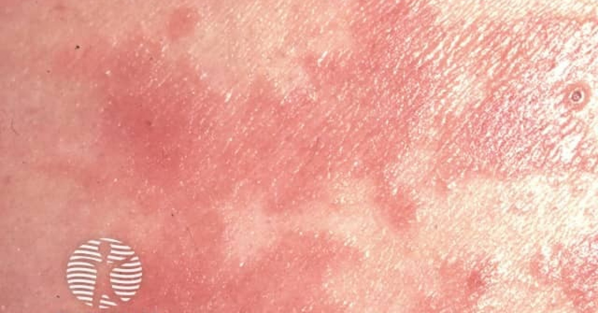 Pityriasis Rubra Symptome _ Pityriasis Rubra Bedeutung – TOLB