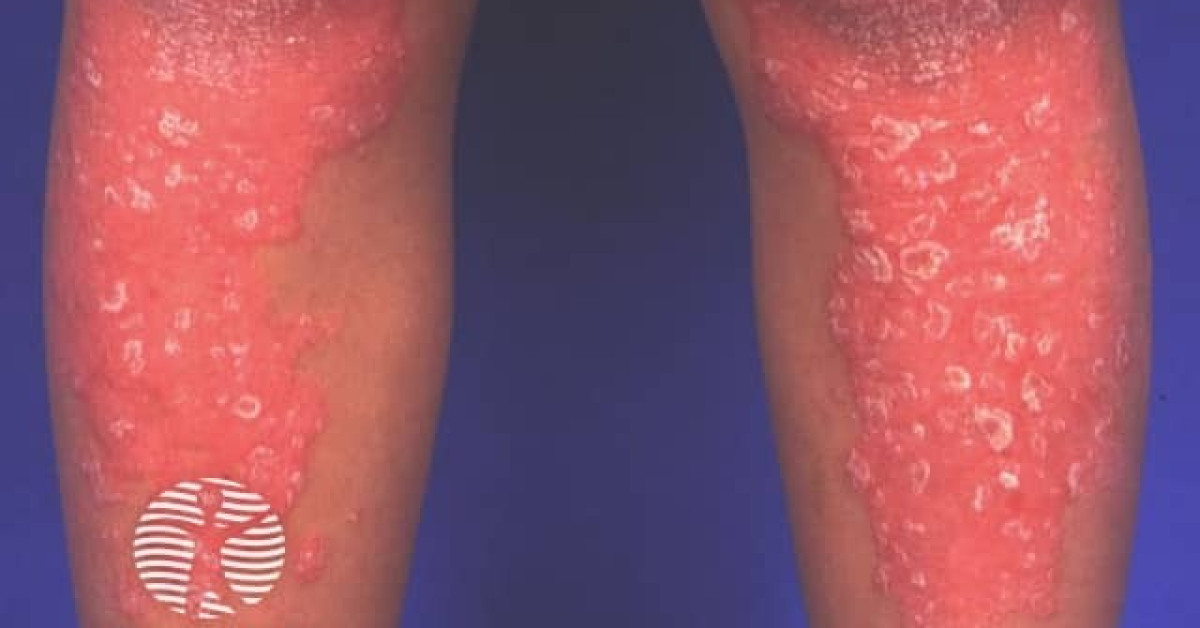 Pityriasis rubra pilaris image