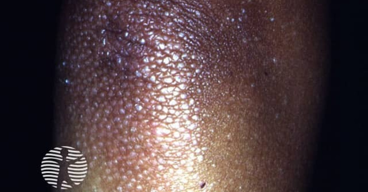 Pityriasis rubra pilaris image