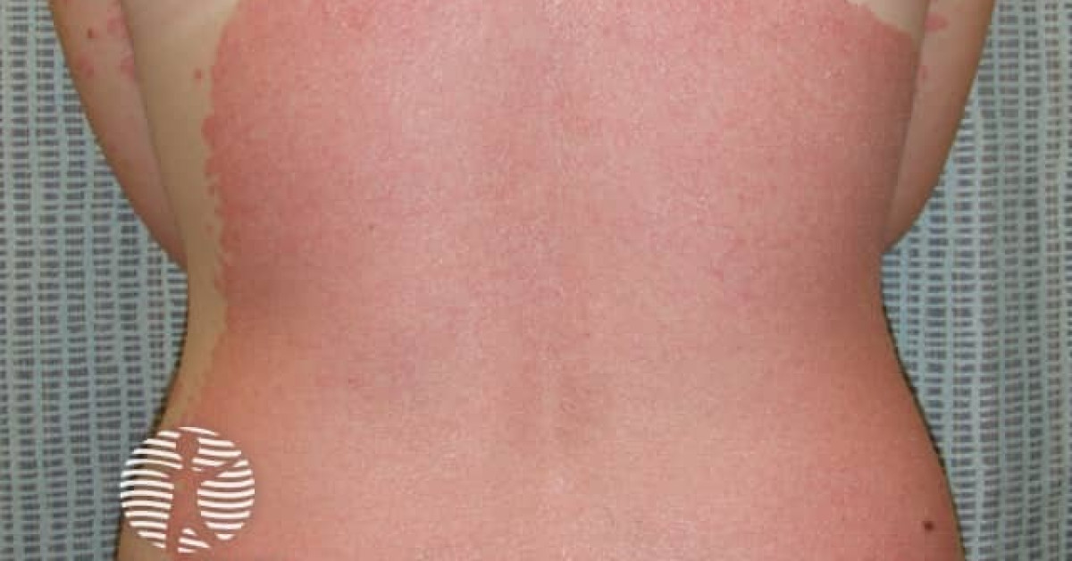 Photosensitive and koebnerised plaque psoriasis arising after mild sunburn image