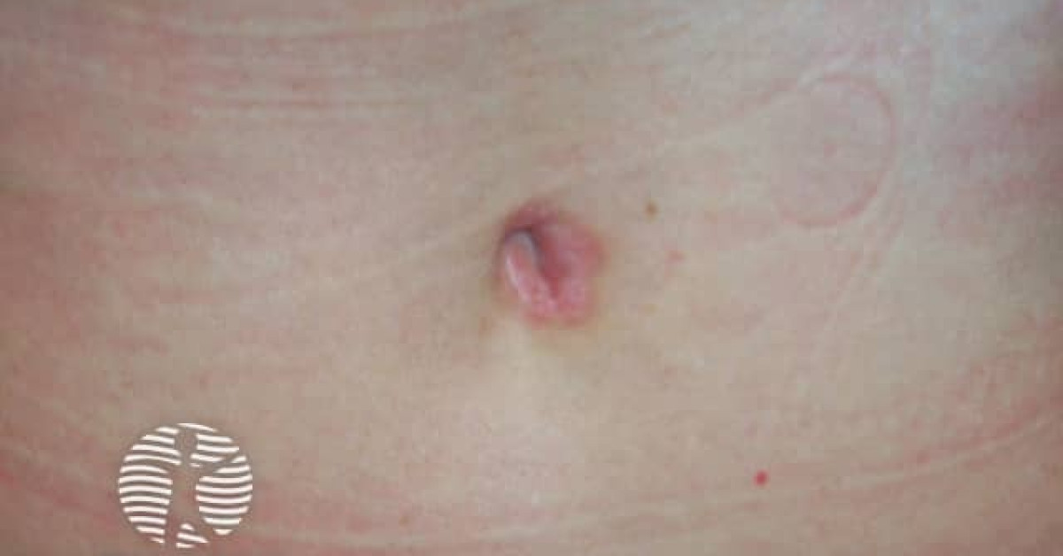 Flexural psoriasis image