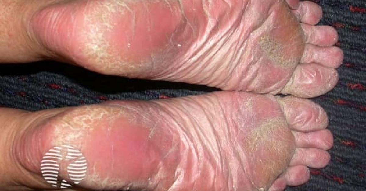 Plantar psoriasis image