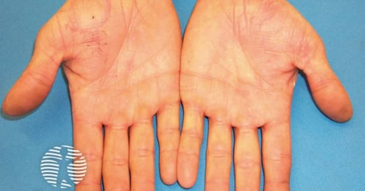 Palmar psoriasis image
