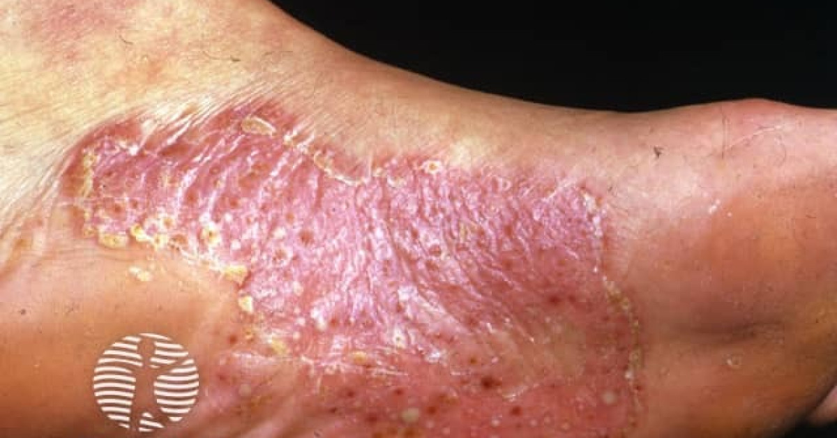 Palmoplantar pustulosis image