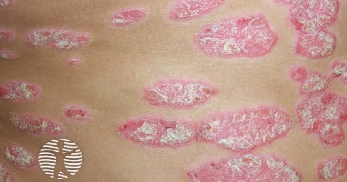 Plaque psoriasis image