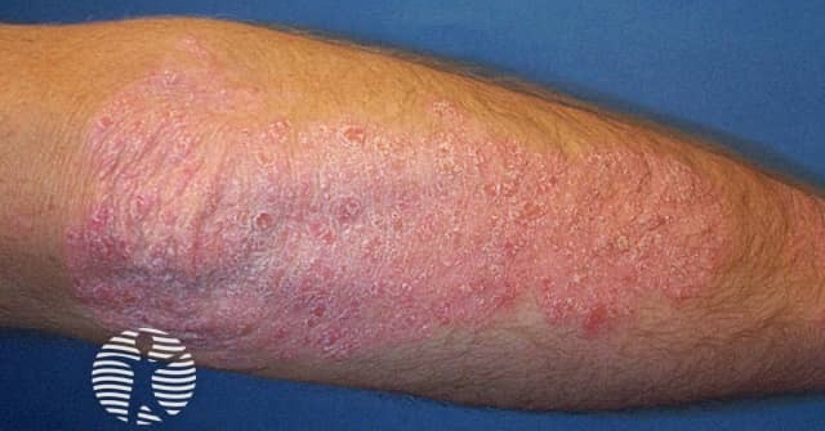DermNet® - Large plaque psoriasis image