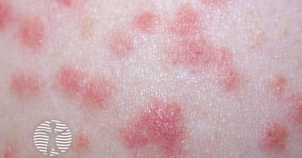 Guttate psoriasis image