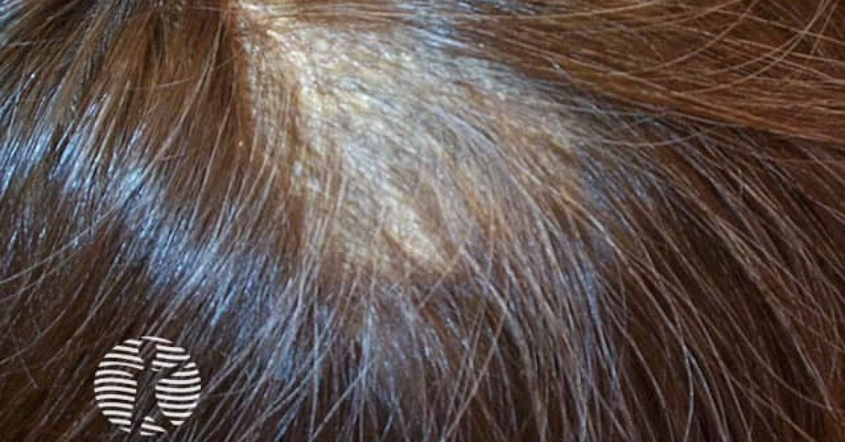 Scalp psoriasis image