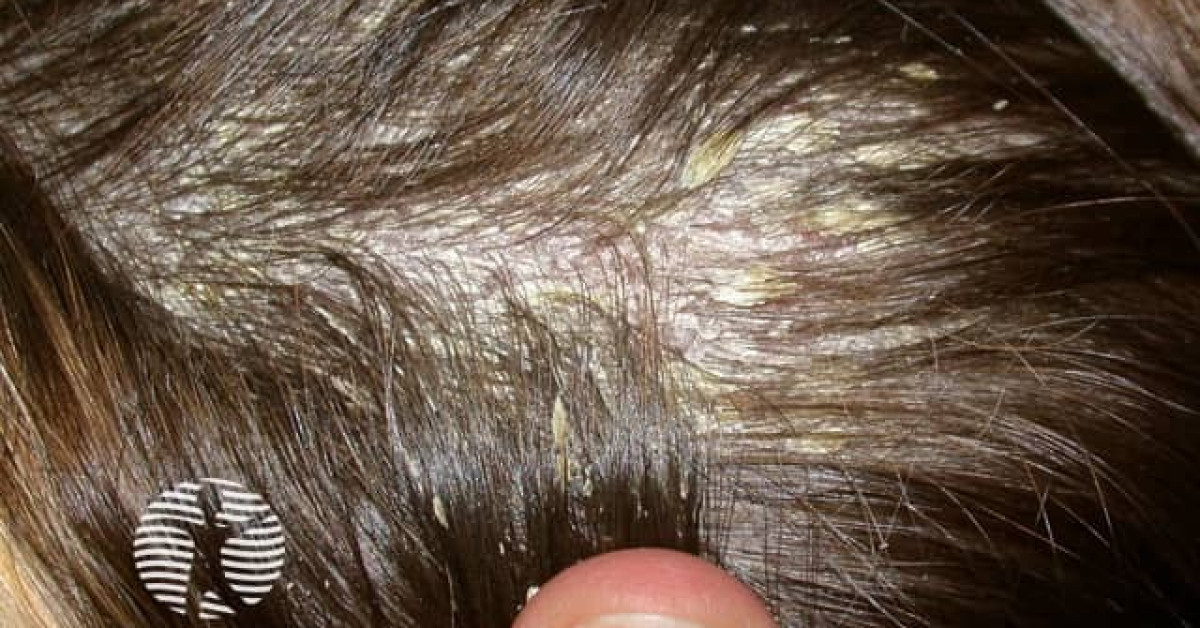 Psoriasis of the scalp image