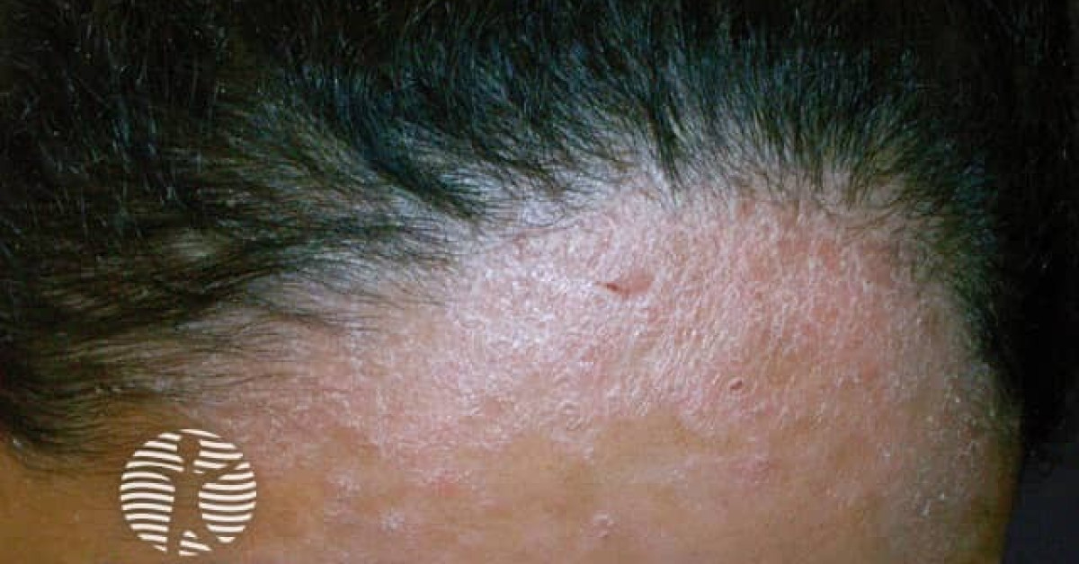 Psoriasis of the scalp image