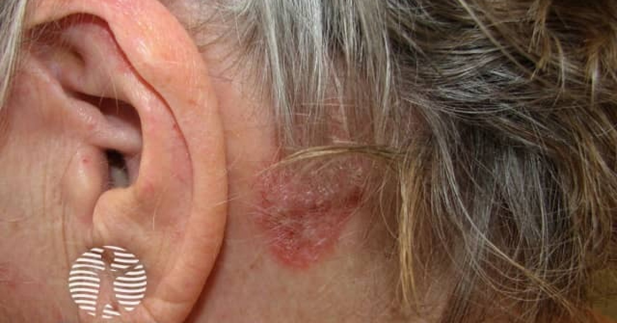 Psoriasis of the scalp image