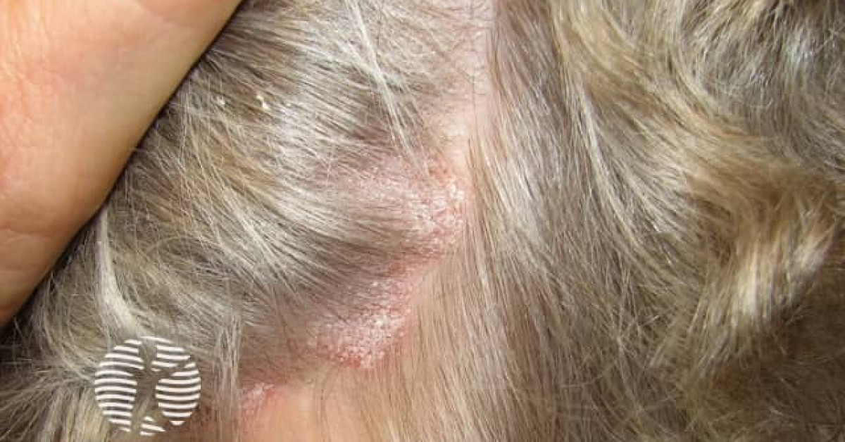 Psoriasis of the scalp image