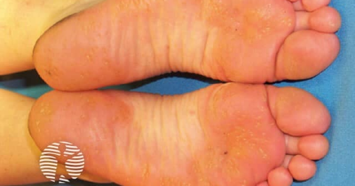 Punctate keratoderma image
