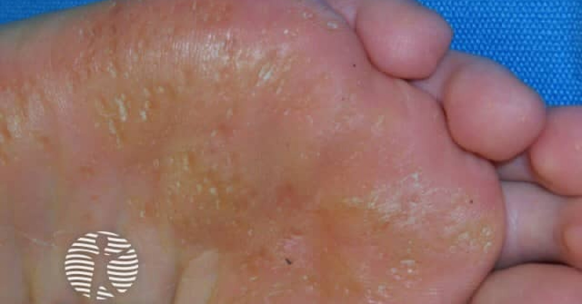 Punctate keratoderma image