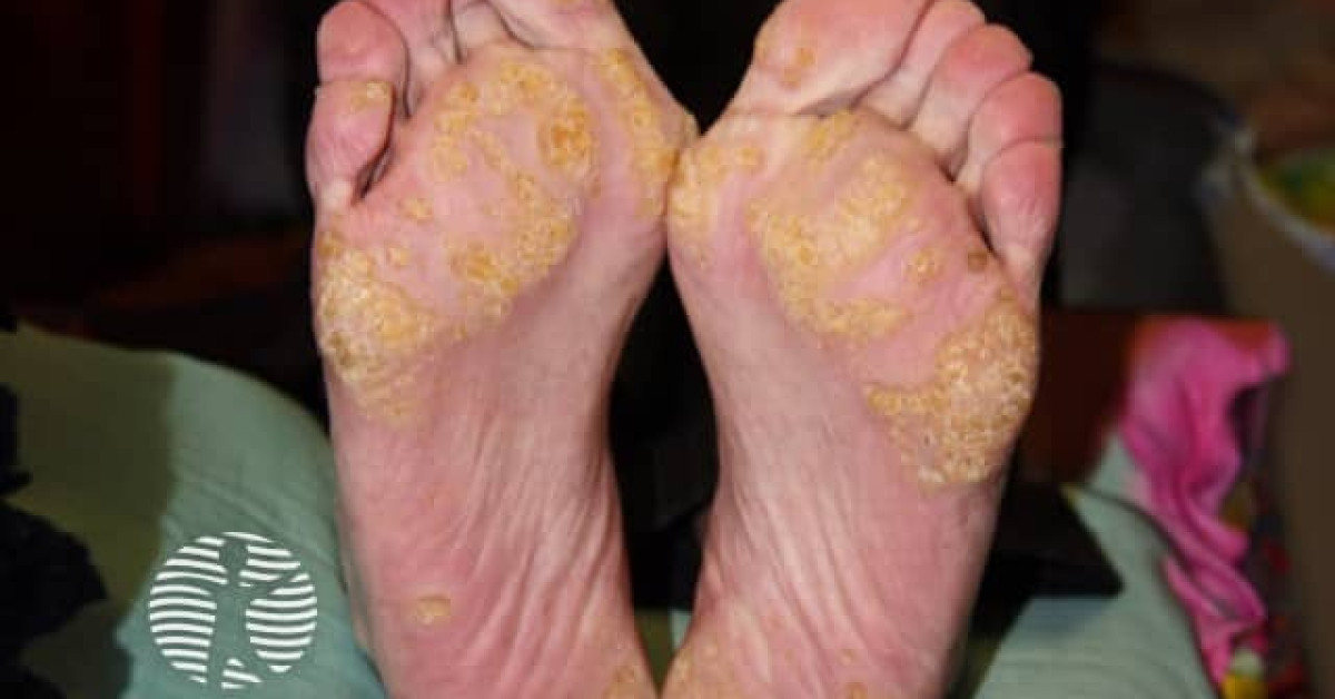 Punctate keratoderma image