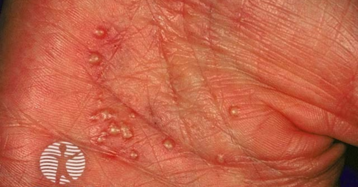 Pustular psoriasis of the hands and fee image