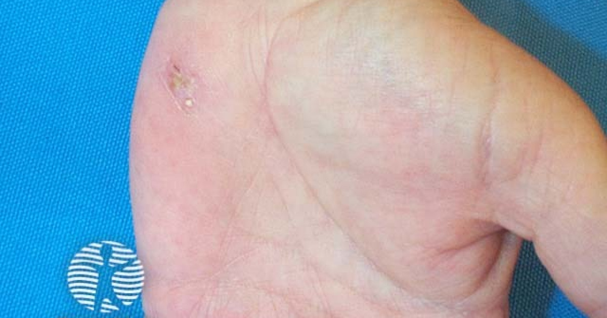 Pustular psoriasis of the hands and fee image