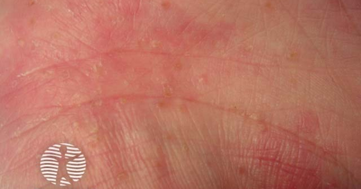 Pustular psoriasis of the hands and fee image