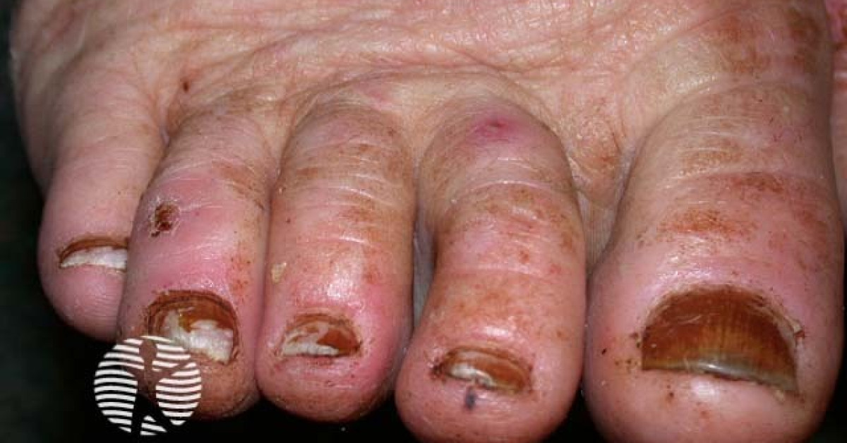 Pustular psoriasis of the hands and fee image