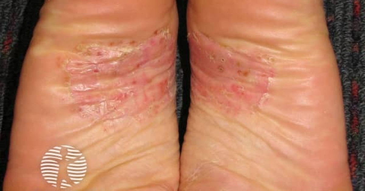 Palmoplantar pustulosis image