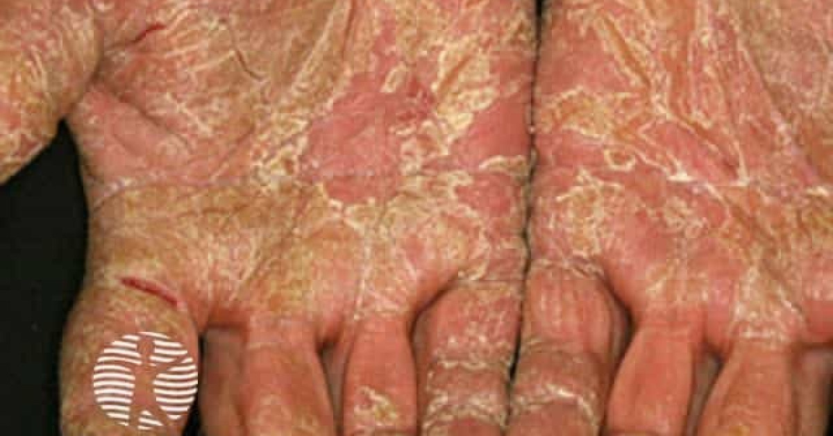 Acquired keratoderma image