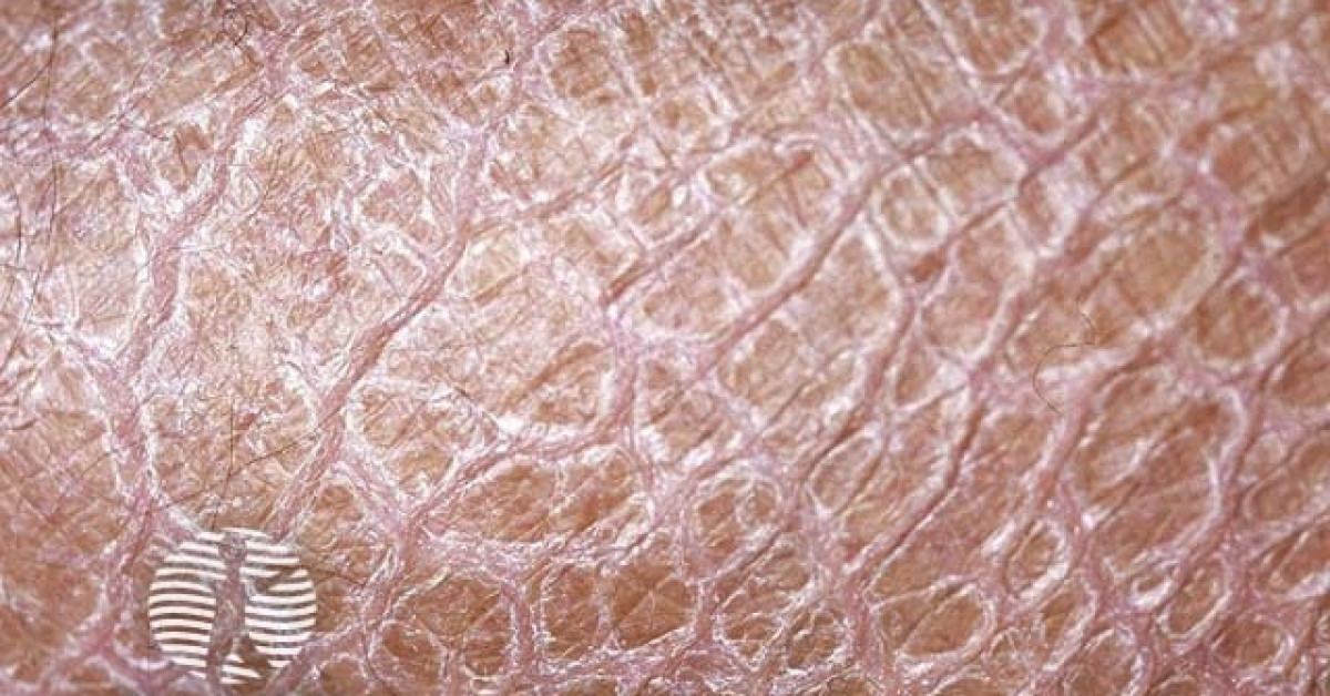 ichthyosis image