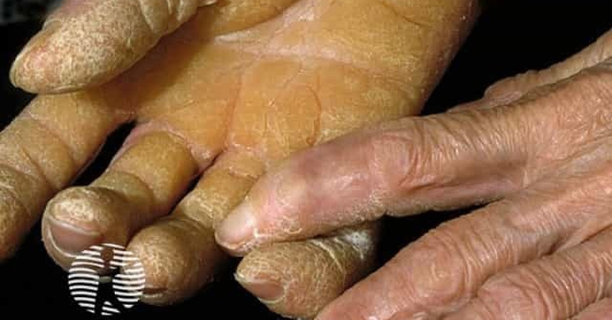 Diffuse palmoplantar keratoderma image