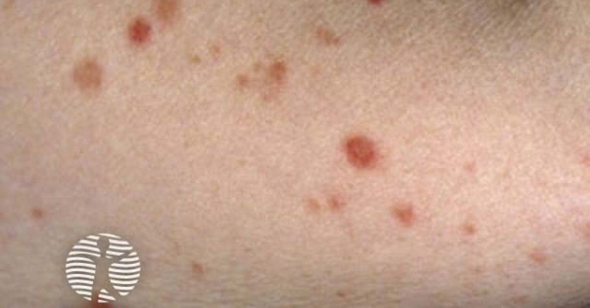 Pityriasis lichenoides chronica image