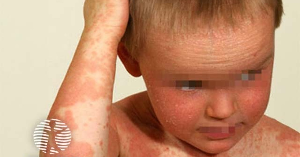 lassical juvenile-onset pityriasis rubra pilaris image