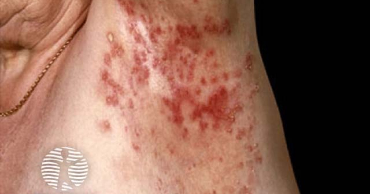 Subcorneal pustular dermatosis image