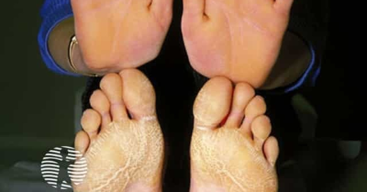 DermNet® - Diffuse palmoplantar keratoderma image