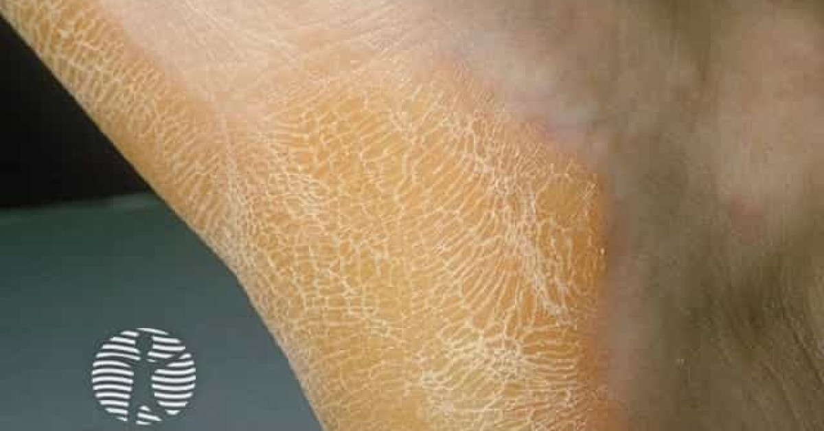 Diffuse palmoplantar keratoderma image