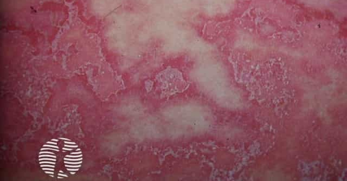 Subcorneal pustular dermatosis image