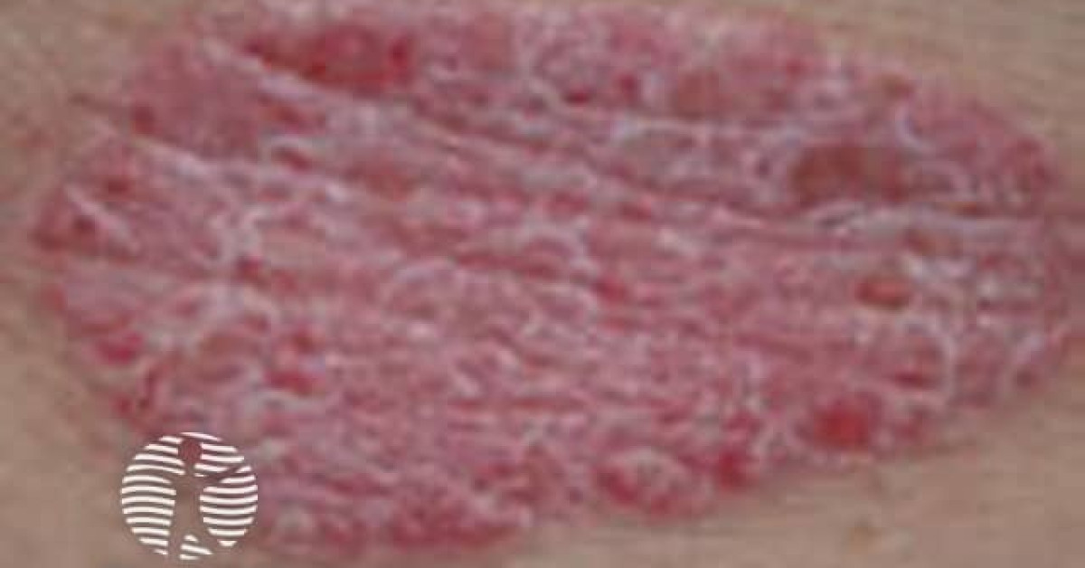 DermNet® - Psoriasis image