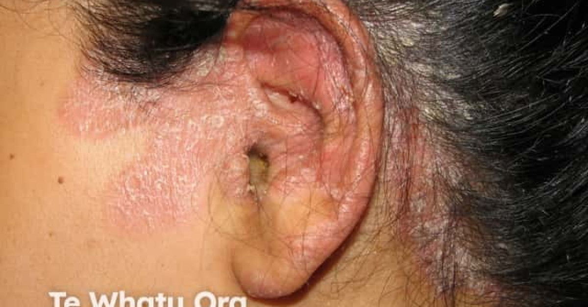 Facial psoriasis image