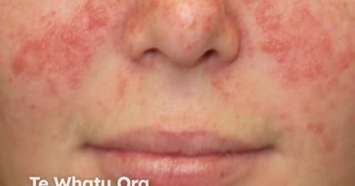 Facial psoriasis image