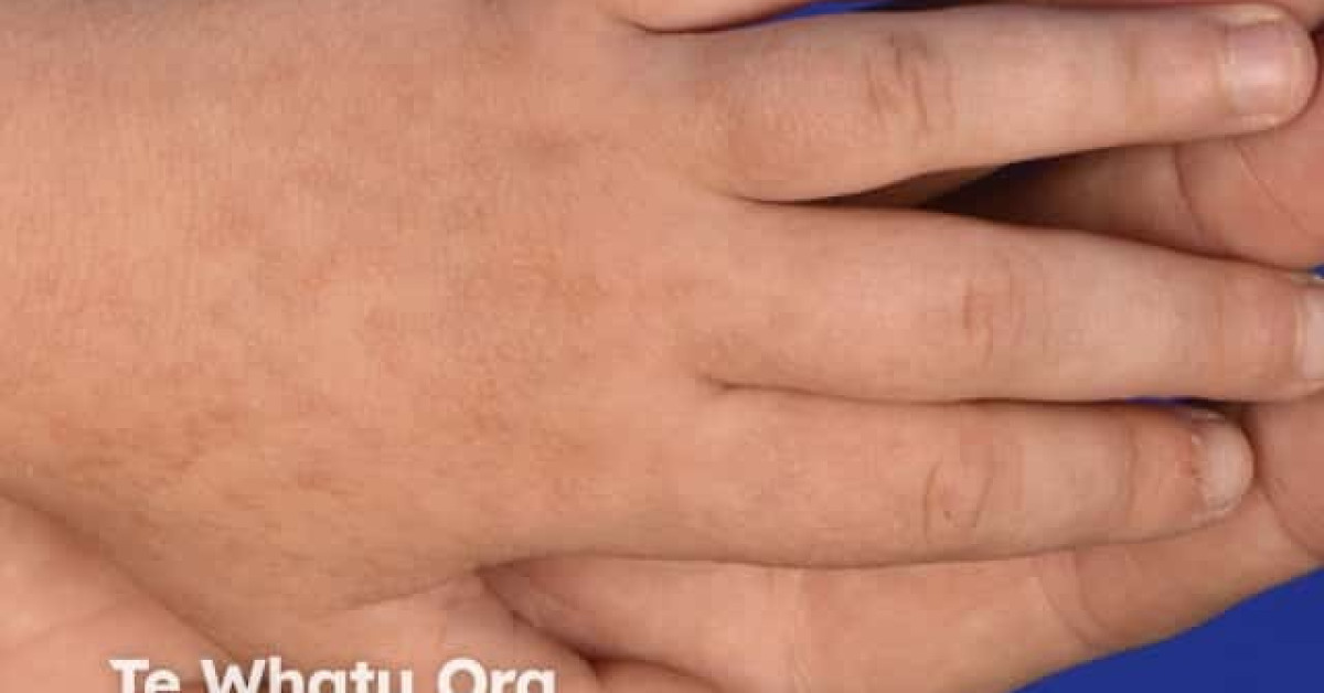 Acrokeratosis verruciformis of Hopf image