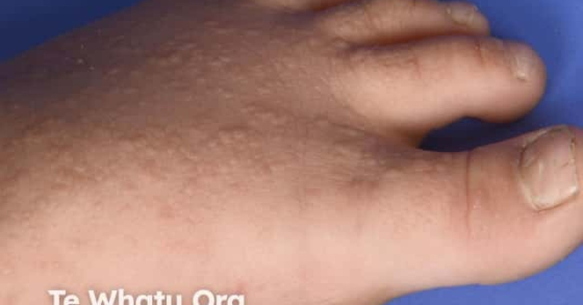 Acrokeratosis verruciformis of Hopf image