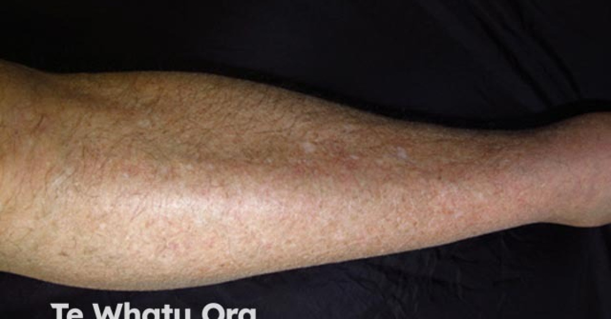 Ichthyosis vulgaris image